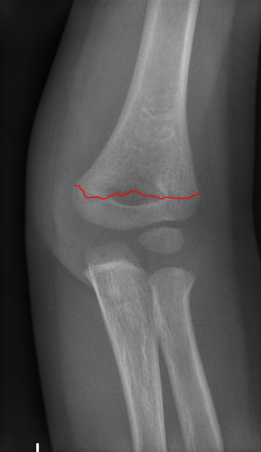 Blount Schlinge - Kinderorthopädie und Kindertraumatologie