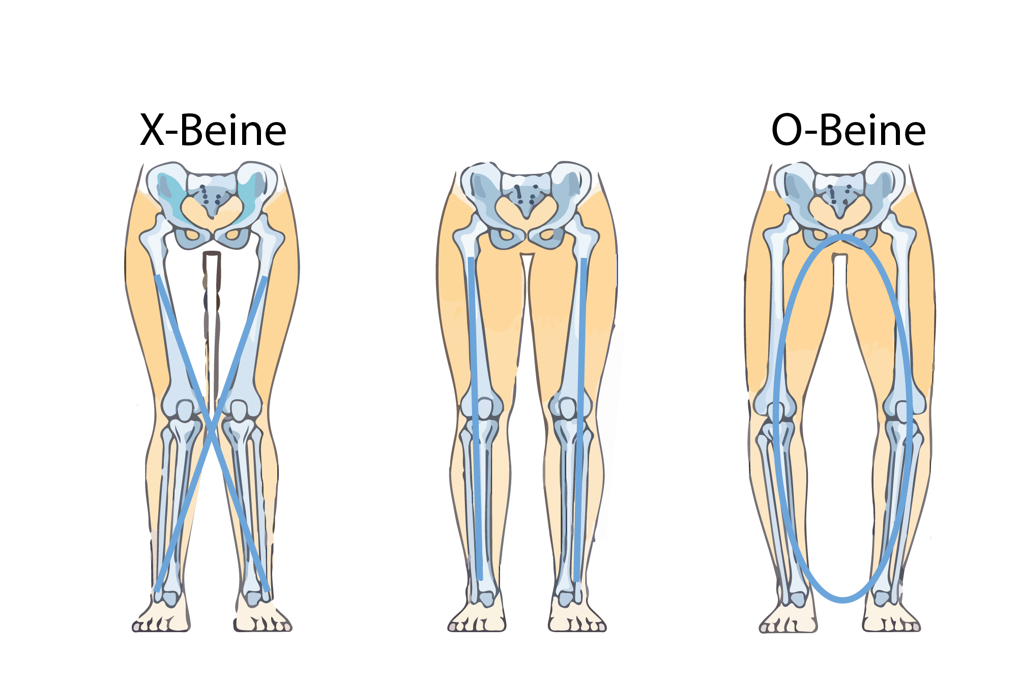 Kinderorthopädie Bern - Kinderorthopädie und Kindertraumatologie